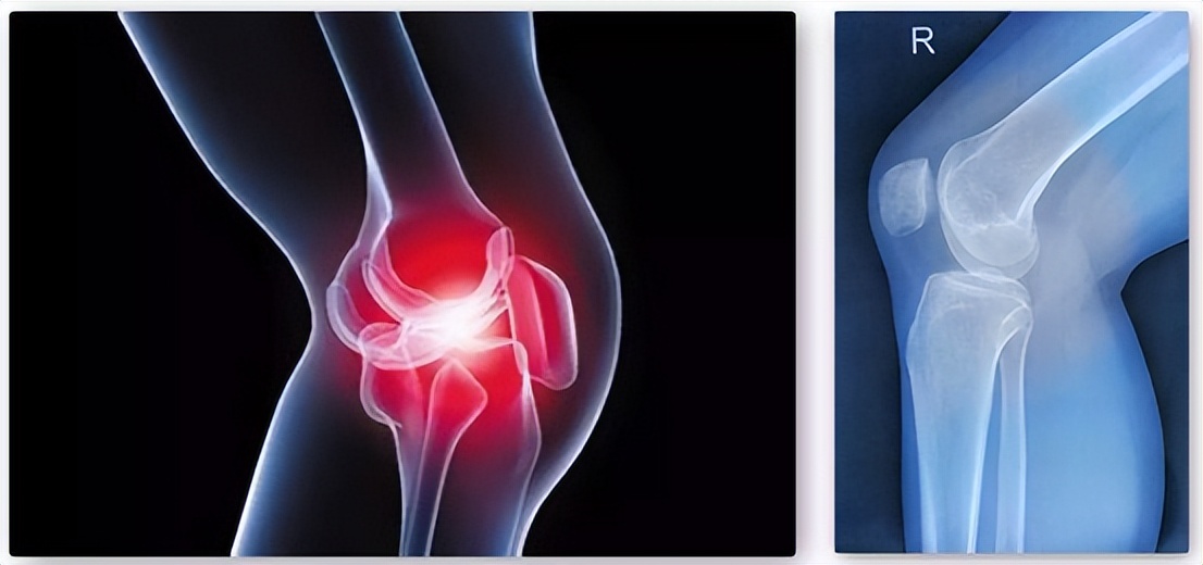 What are the symptoms of knee synovitis?What are the treatments for ...