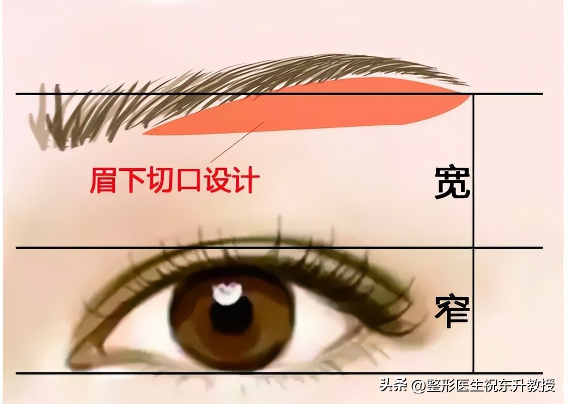 It took more than an hour to do the eyebrow lifting operation, the real ...