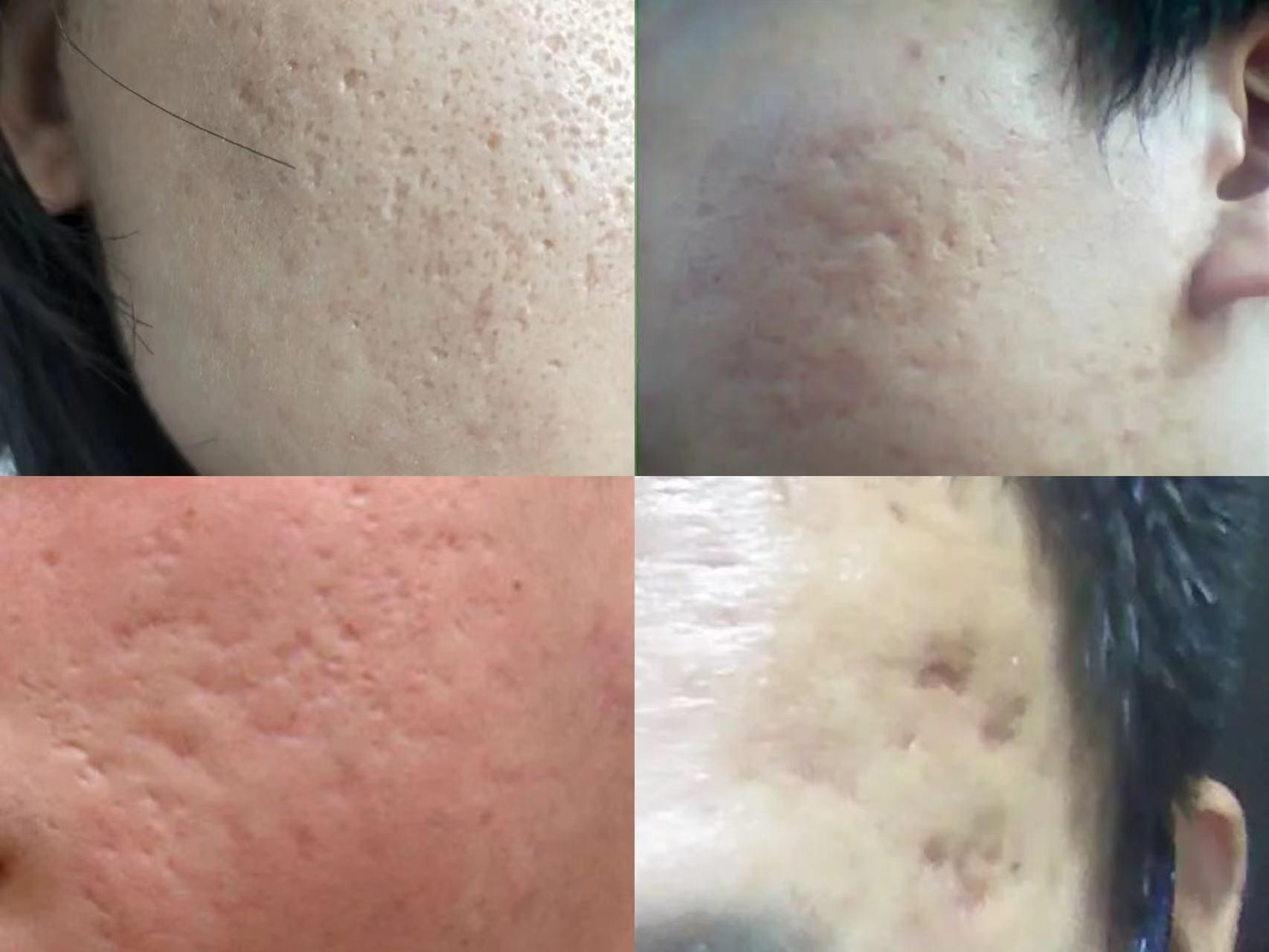 What to do with acne pits?Enough to read this - iNEWS