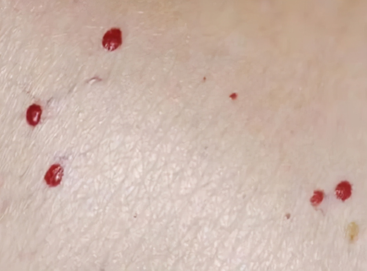 Is the red dot on the body a problem with the liver? - iNEWS
