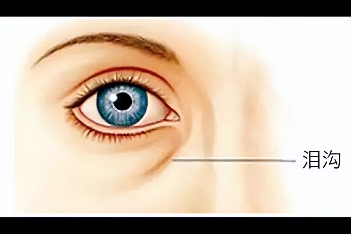 How to remove the most reliable tear trough - iMedia