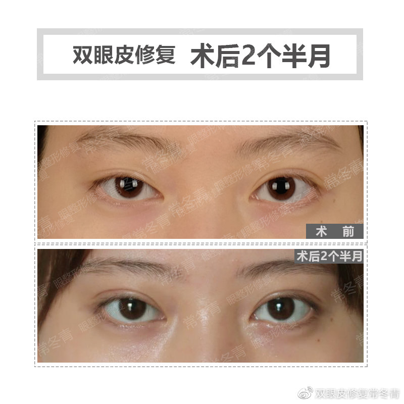 Double eyelid repair 5 months photo feedback - big and small eyes ...