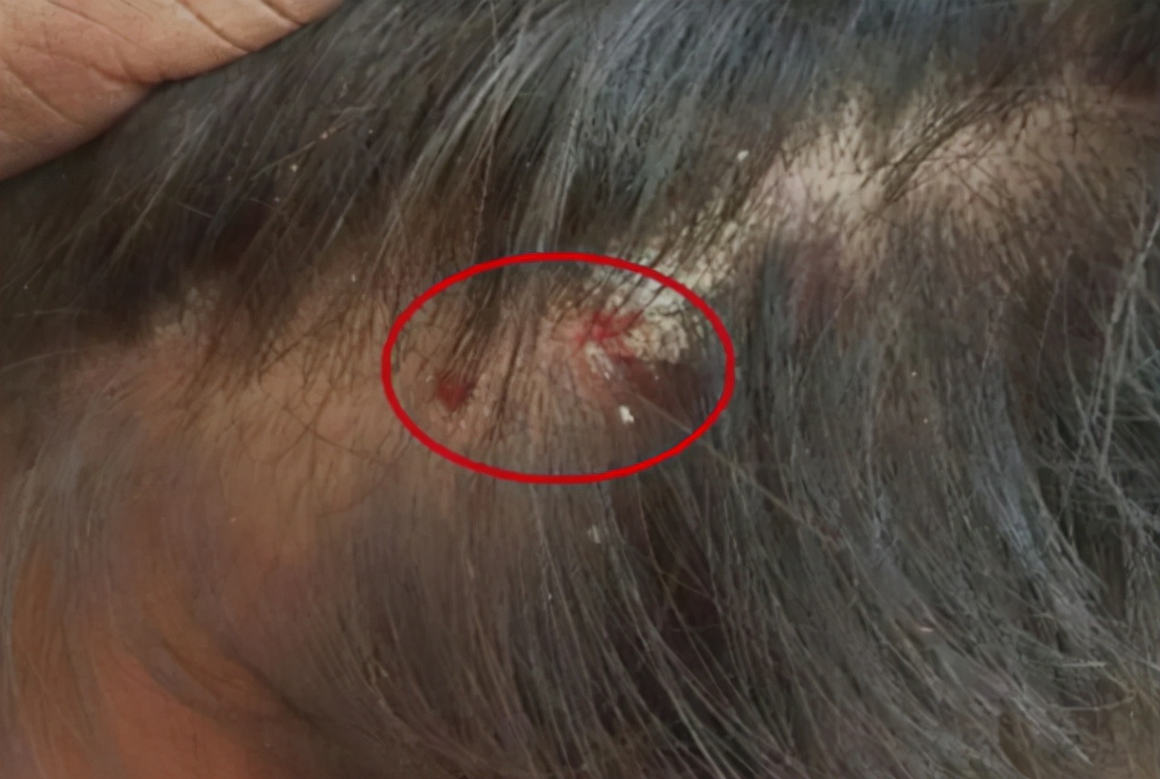 Why does the scalp have "pimples" and "pustules"?Maybe it is related to ...