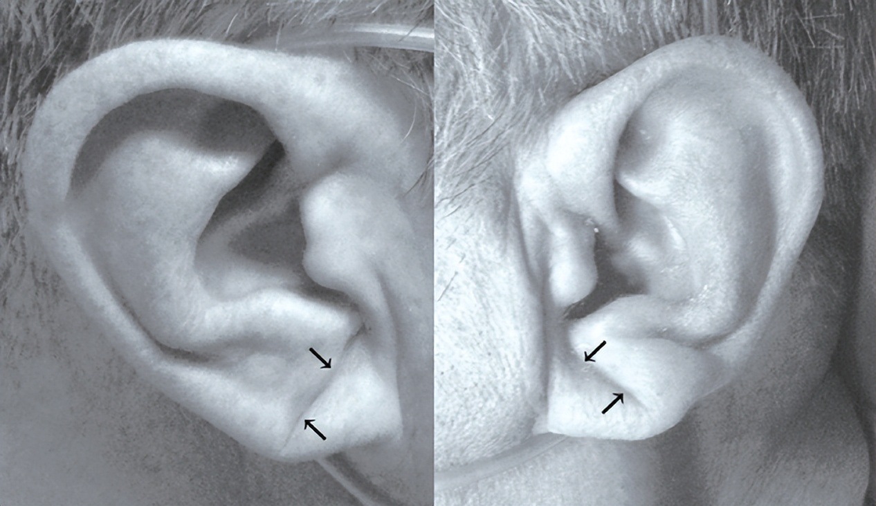 A crease on the earlobe can reveal a heart attack? - iNEWS
