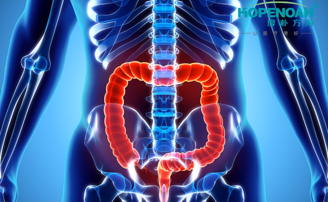 "Where is the way" in the treatment of advanced colorectal cancer? Dual ...