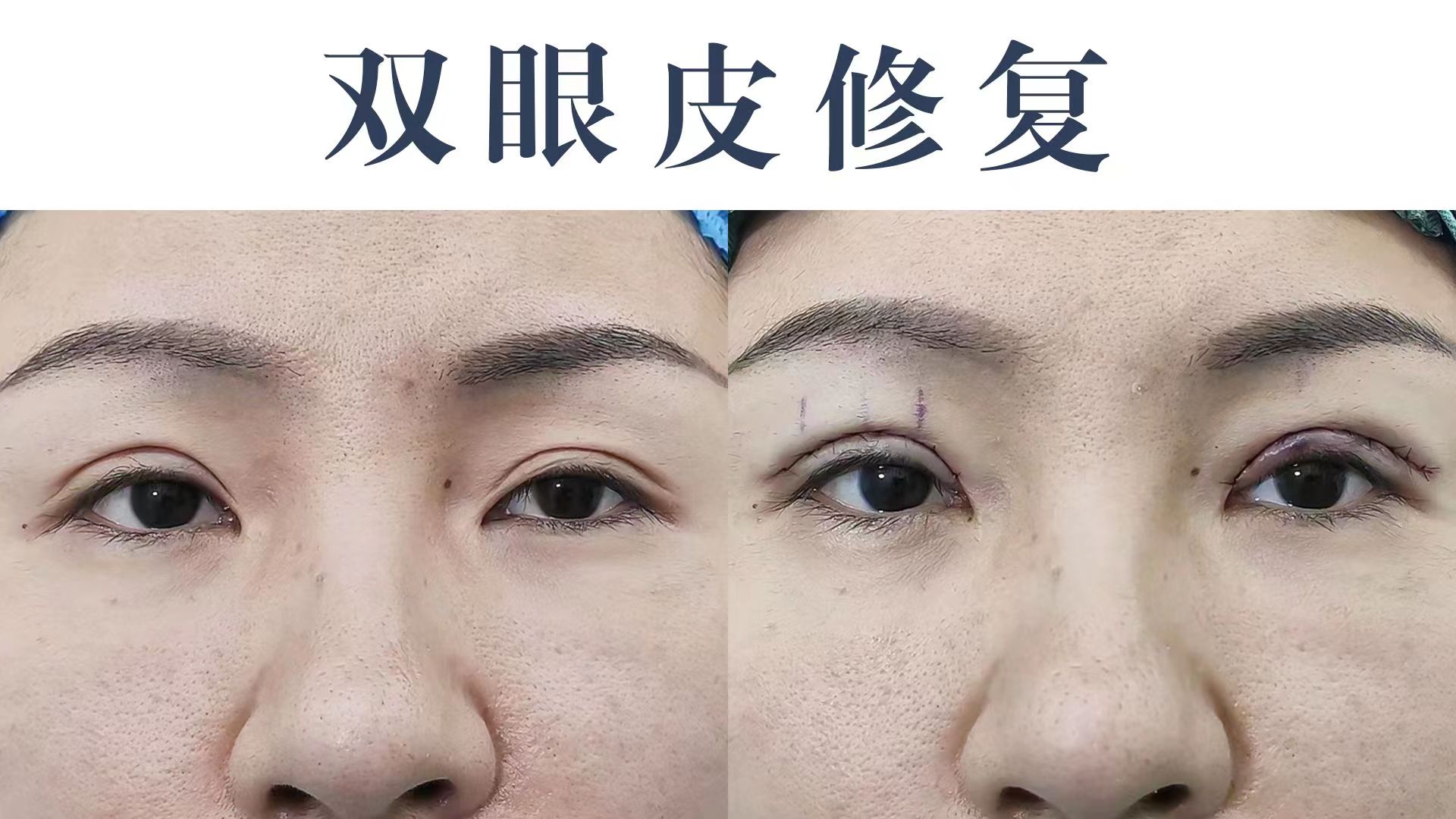 What should I do if the double eyelid shape is parallel and looks old ...