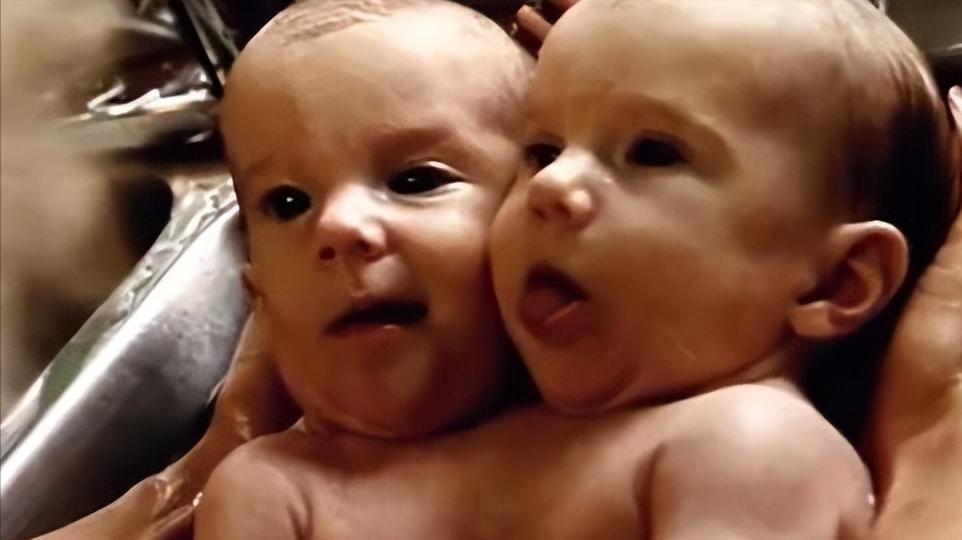 American Conjoined Twins: Sharing the same body and marrying the same ...