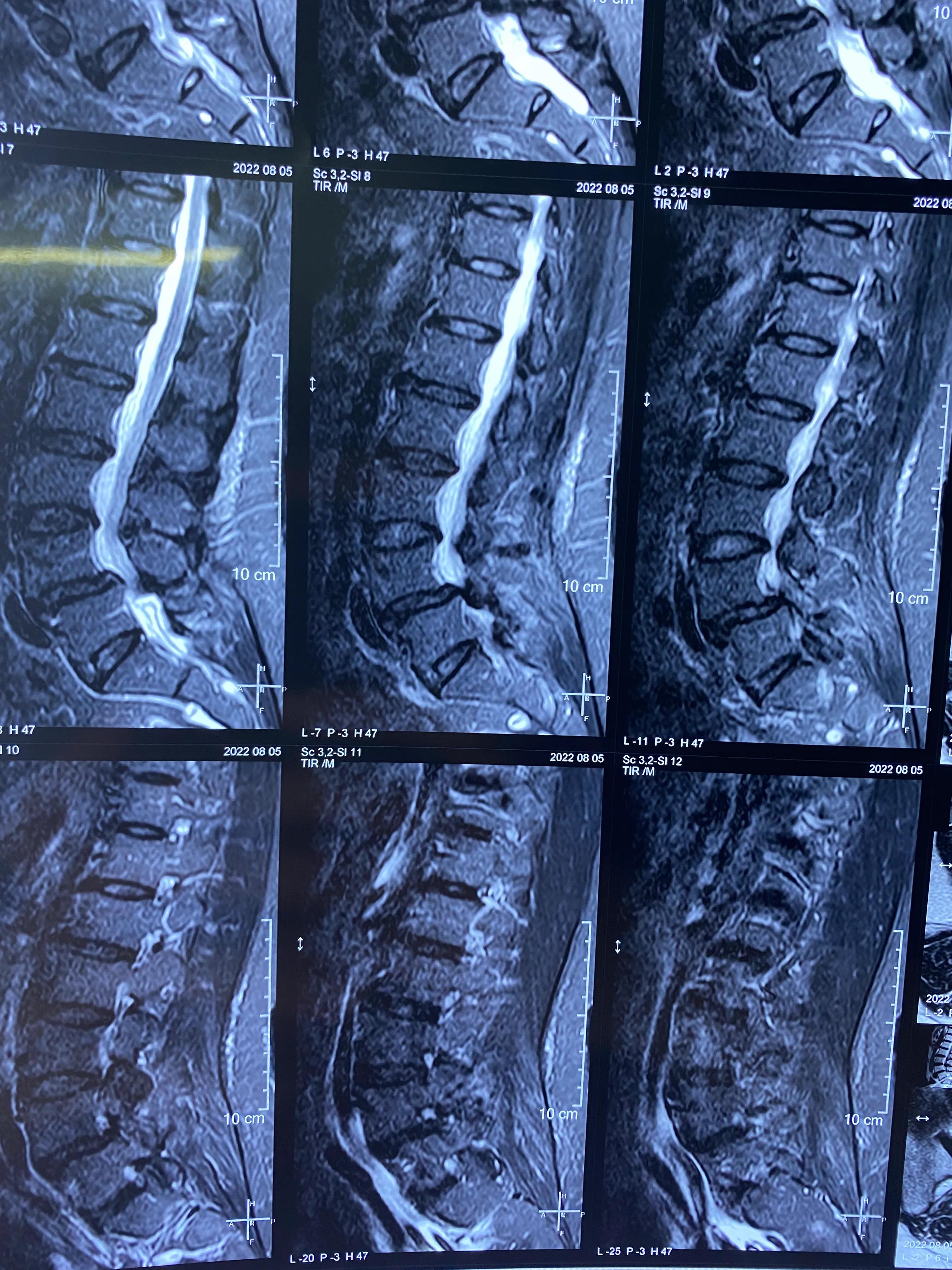 MRI, CT and ordinary film to see the popular analogy of bananas - iNEWS