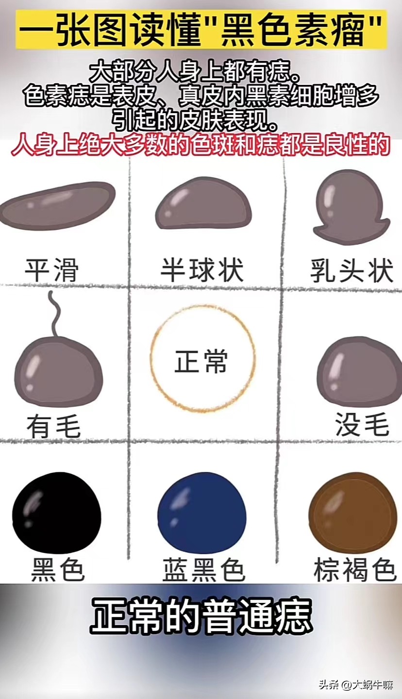 How to tell the difference between a normal mole and a melanoma? - iNEWS