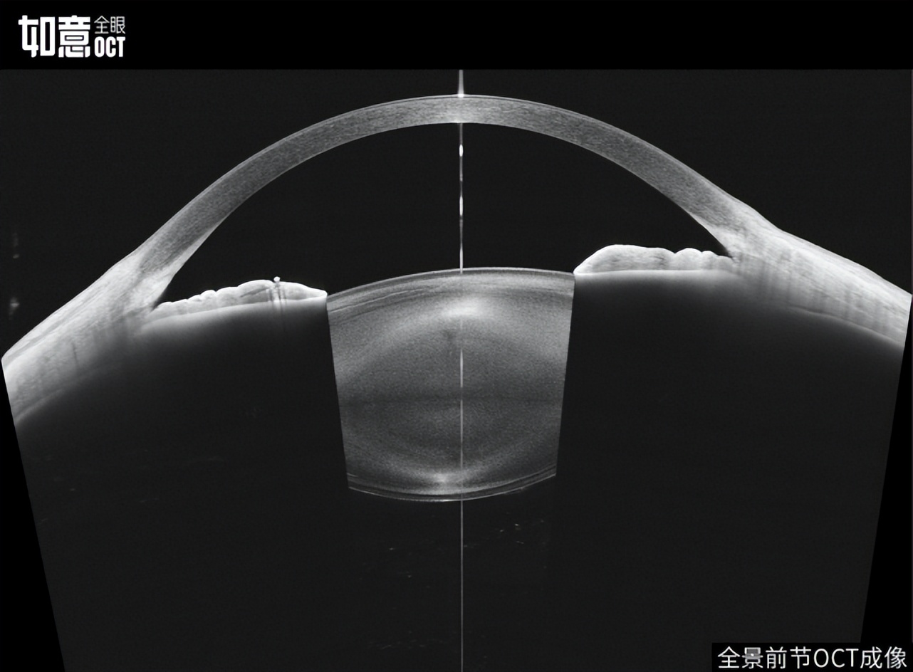 Whole-axis visualization biometrics and OCT are perfectly integrated ...