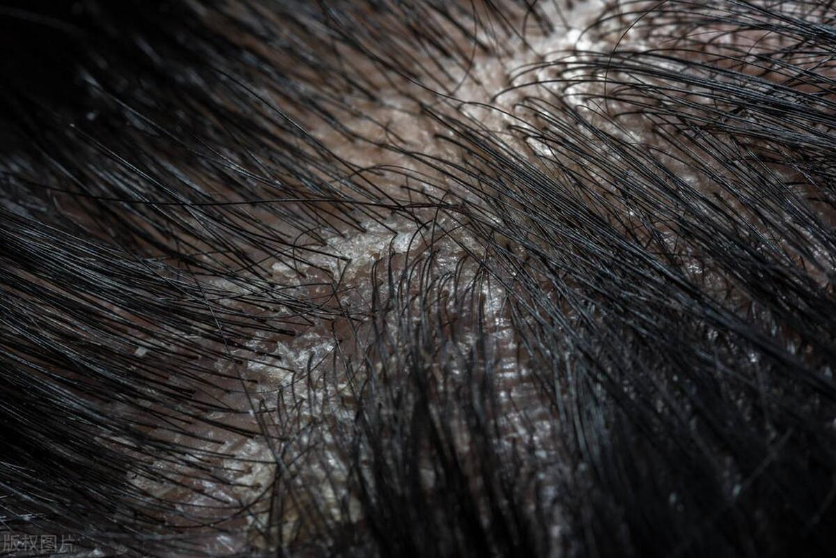 There are always pimples and pustules on the scalp, which may be the ...