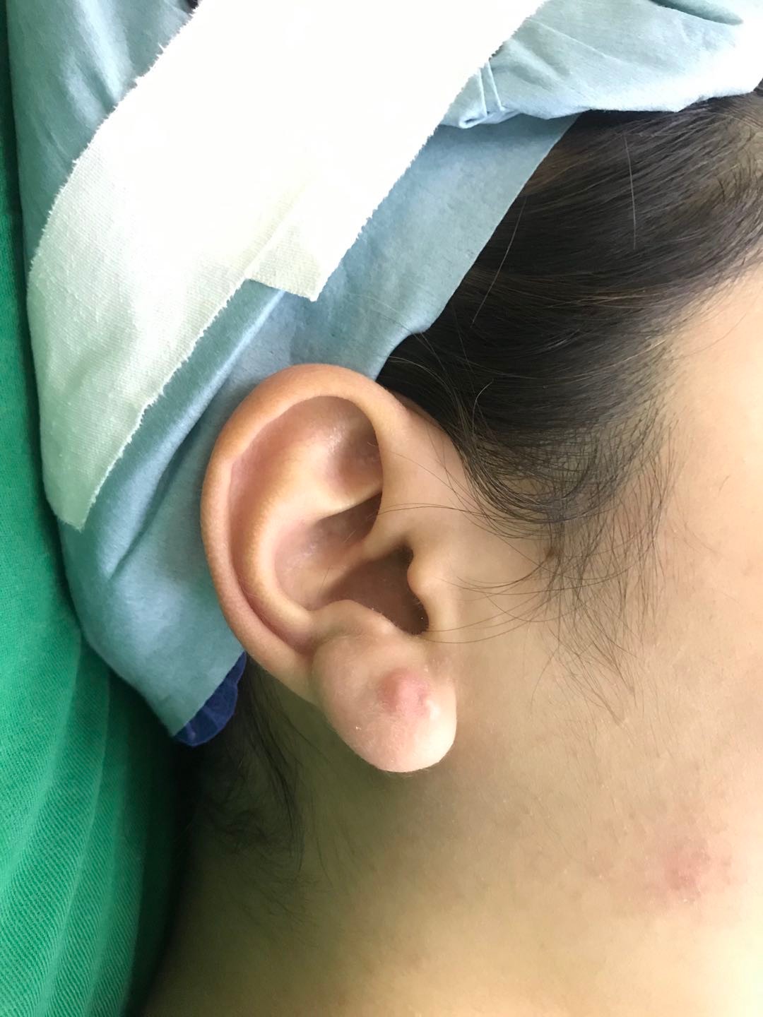 How to get rid of pimples on ears? - iNEWS