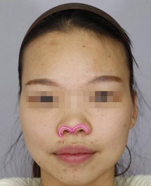 How to improve a nose with a flat nose bridge and tip? - iNEWS