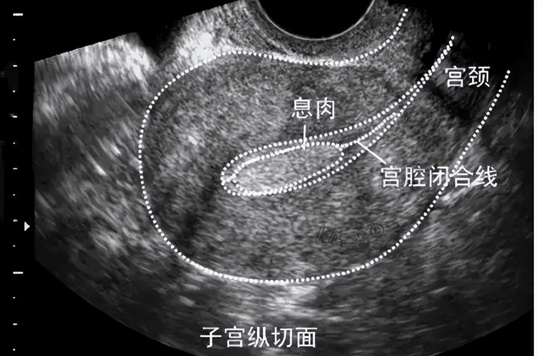 Endometrial polyps, how to get a good pregnancy? - iNEWS