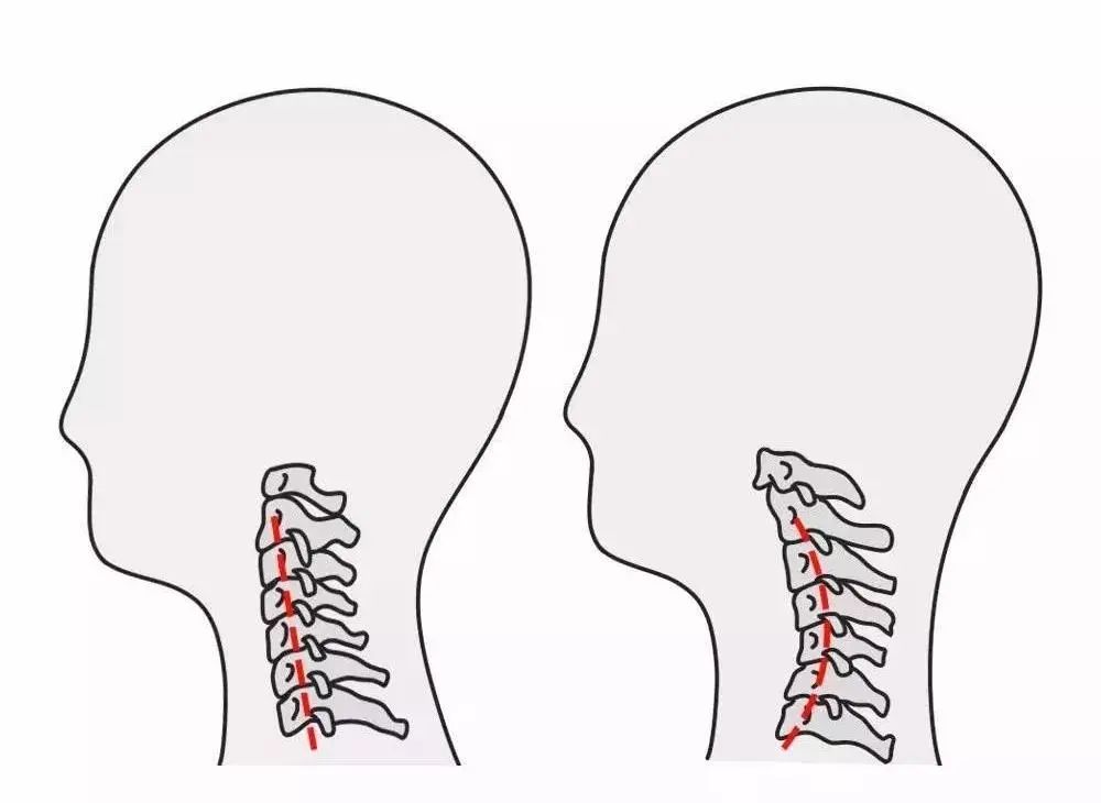 The neck is getting more and more painful, your cervical spine may be ...