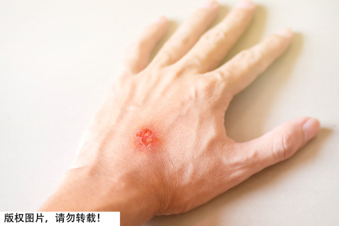 Why is the scab so itchy?The more you pull the top?hurry up... - iNEWS