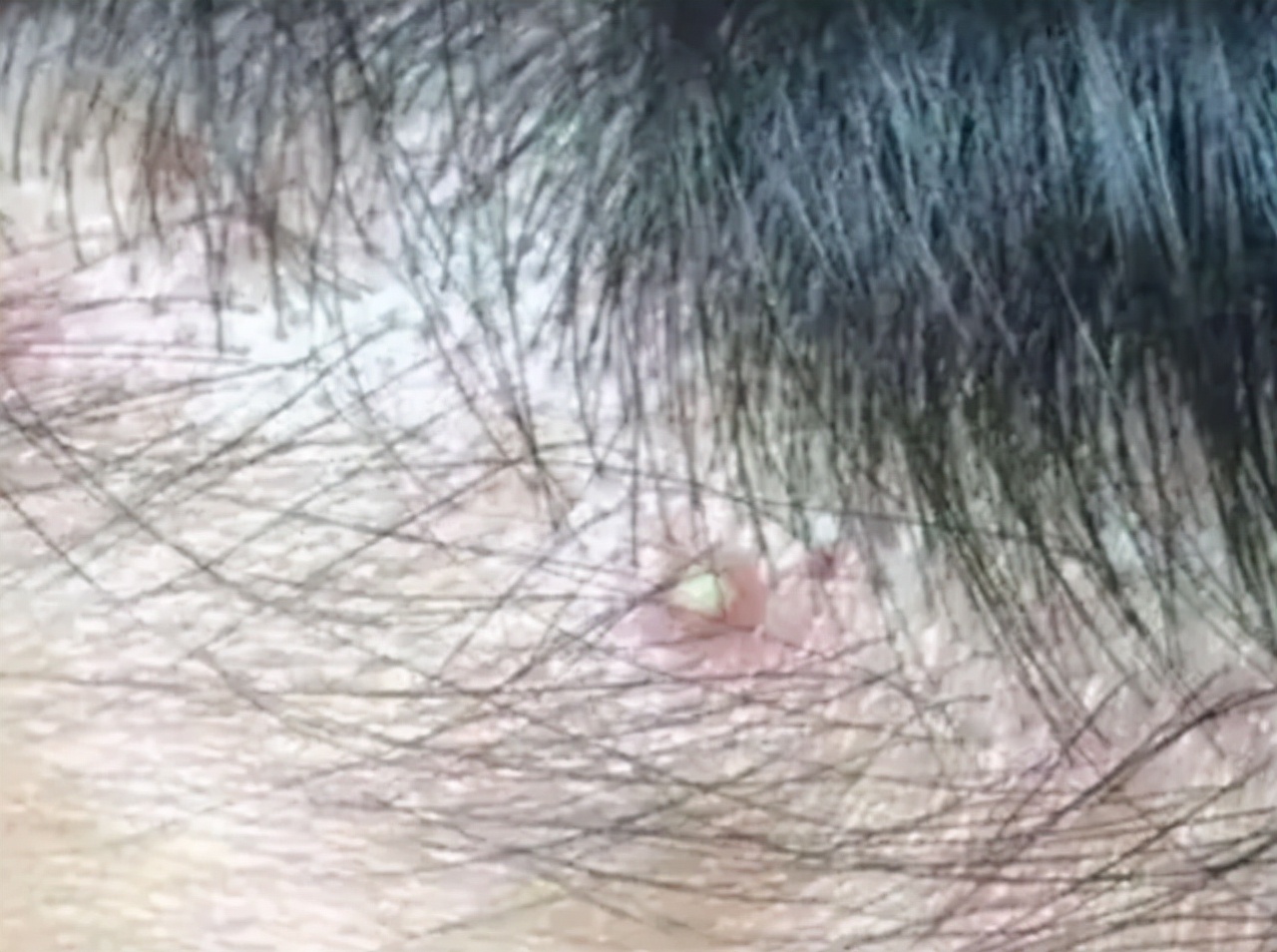 Why do pustules and bumps always grow on the scalp? That may be related ...