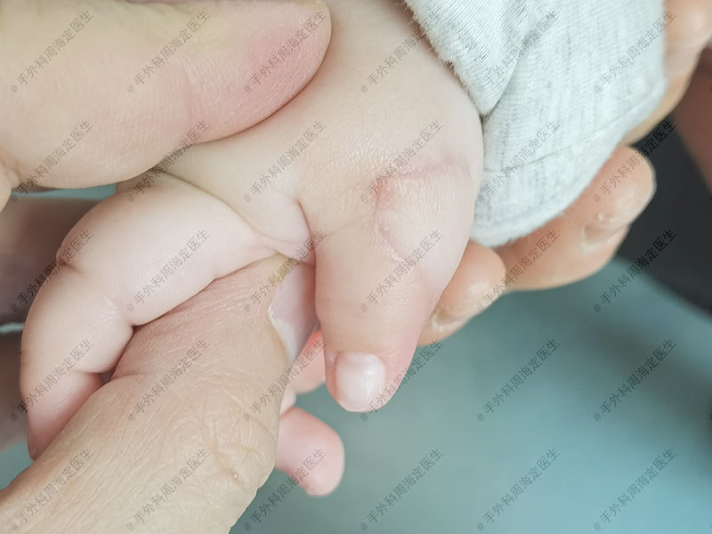 Newborn baby with crab claw polydactyly, can it return to normal ...
