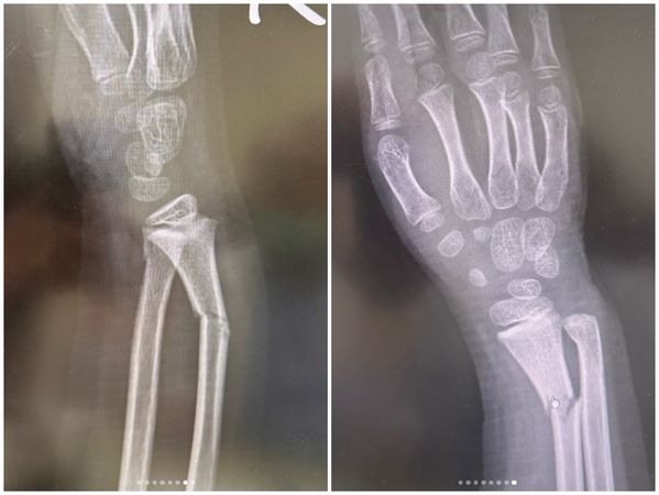 Bai Jiaqi's 6-year-old child "tripped on the way to school" and broke ...